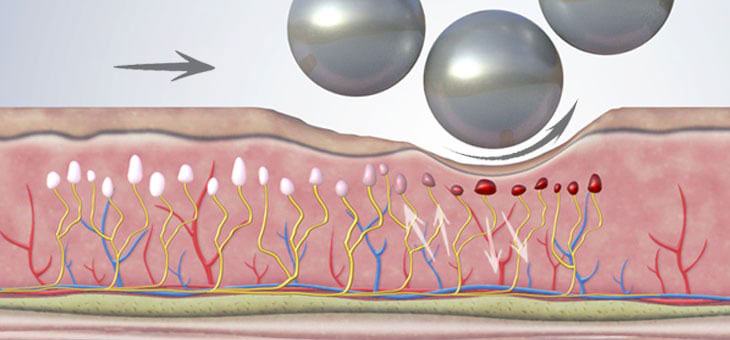 ENDOSFERA oblikovanje tijela redukcija celulita
