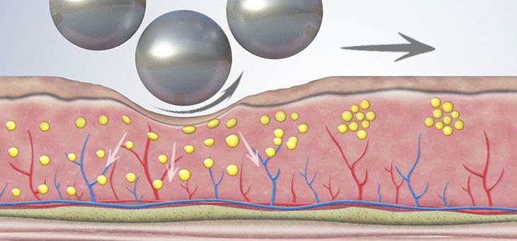 ENDOSFERA oblikovanje tijela redukcija celulita