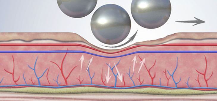 ENDOSFERA oblikovanje tijela redukcija celulita