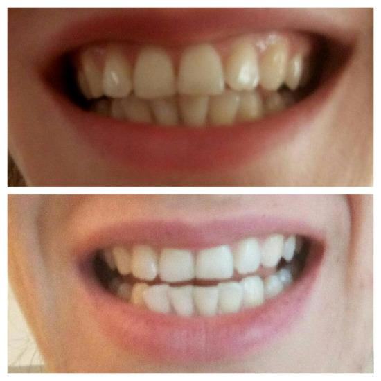 Crest trakice za zube