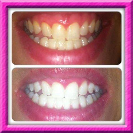 TRAKICE ZA IZBJELJIVANJE ZUBI/CREST 3D WHITE (GARANCIJA PROZVODA 100%)